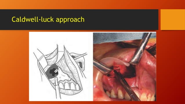 complications of tooth extraction | PPTX