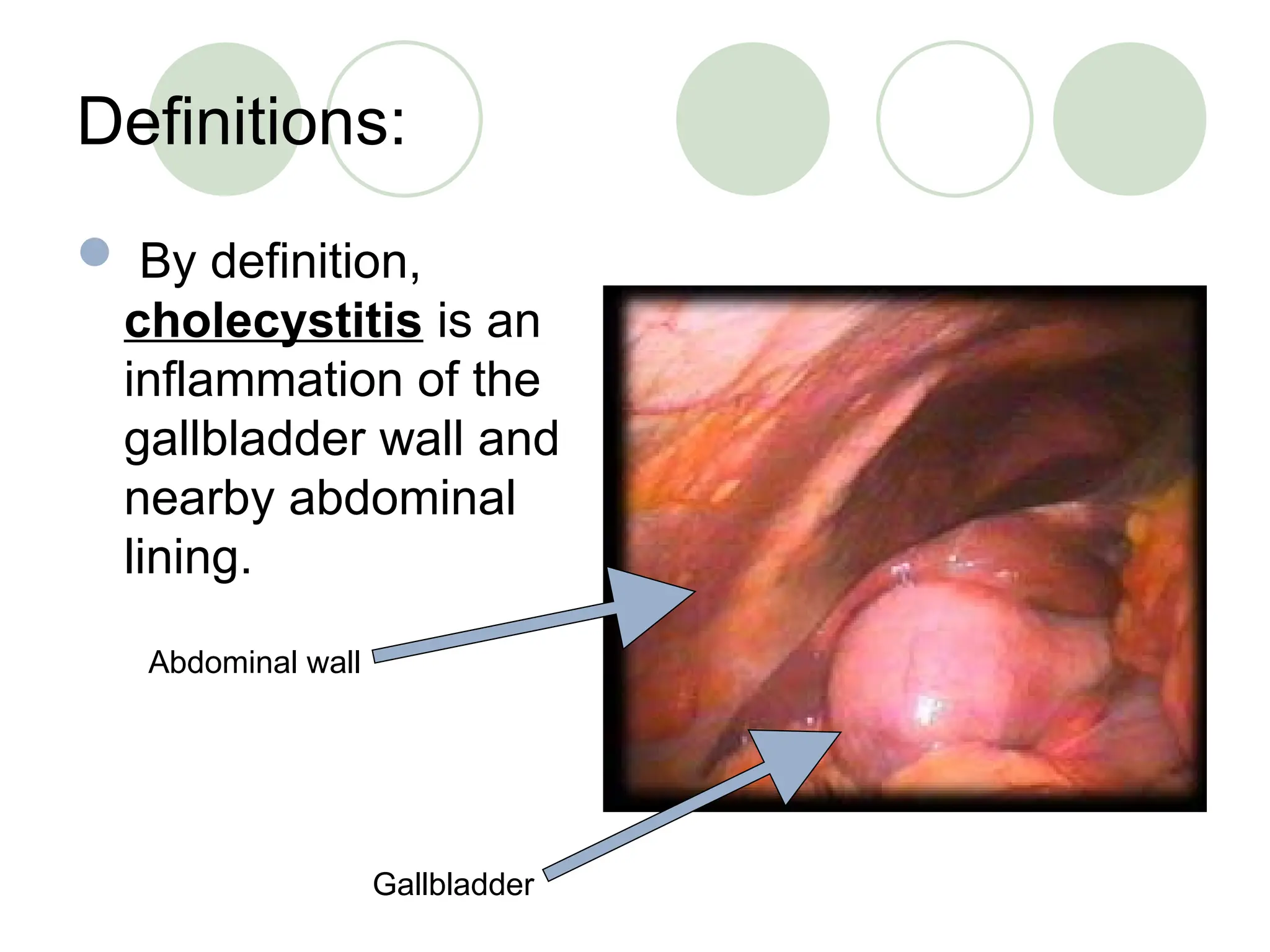 LEC12-cholecystitis-cholelithiasis.power point | PPT