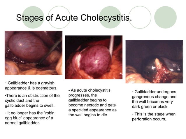 LEC12-cholecystitis-cholelithiasis.power point | PPT