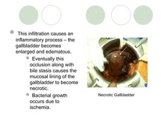 LEC12-cholecystitis-cholelithiasis.power point | PPT