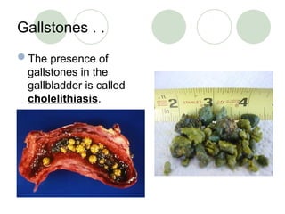 LEC12-cholecystitis-cholelithiasis.power point | PPT