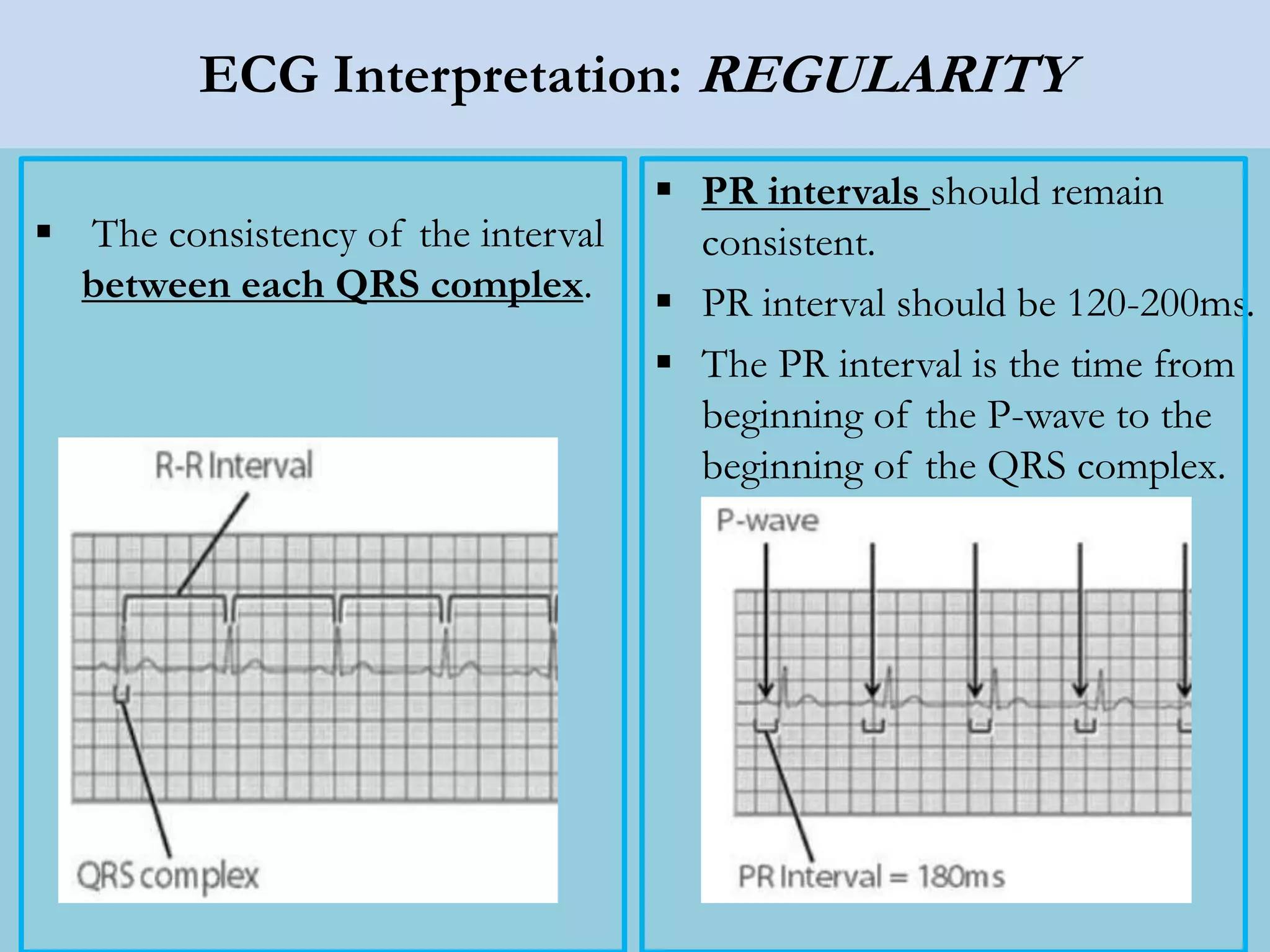 Lec 14 basic ecg interpretation for mohs | PPTX