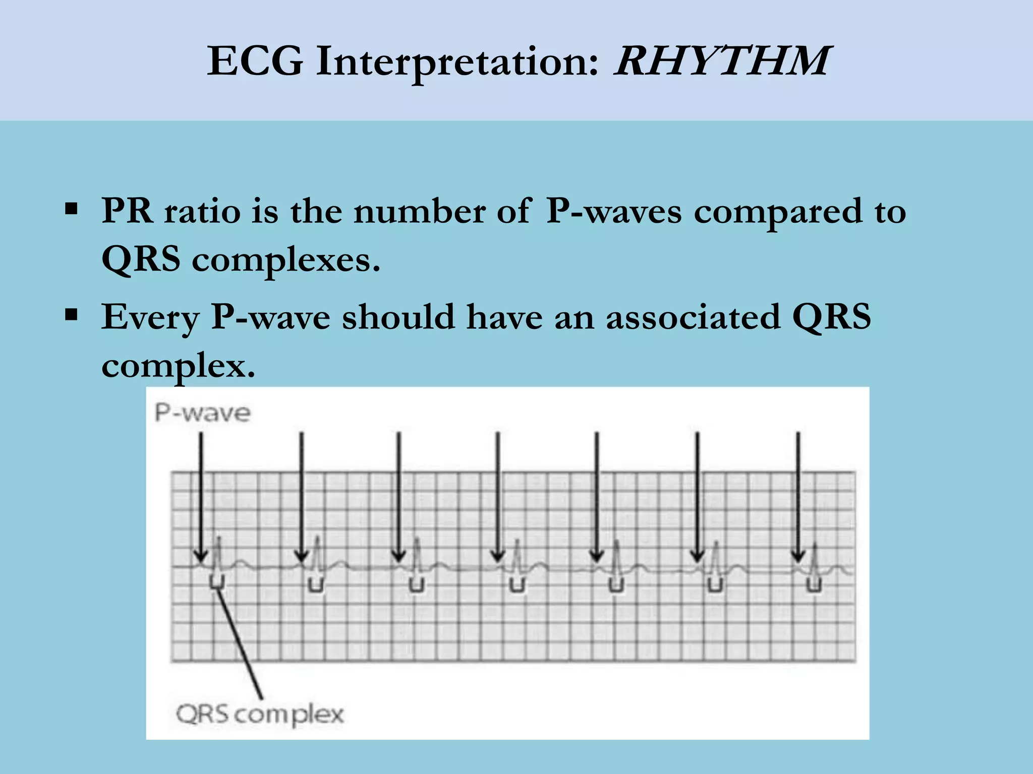 Lec 14 basic ecg interpretation for mohs | PPTX
