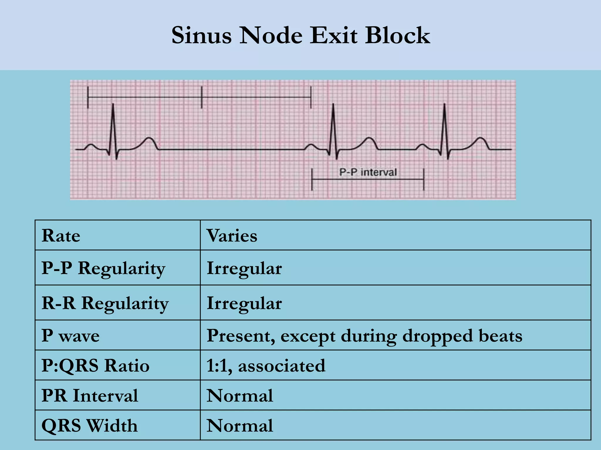 Lec 14 basic ecg interpretation for mohs | PPTX