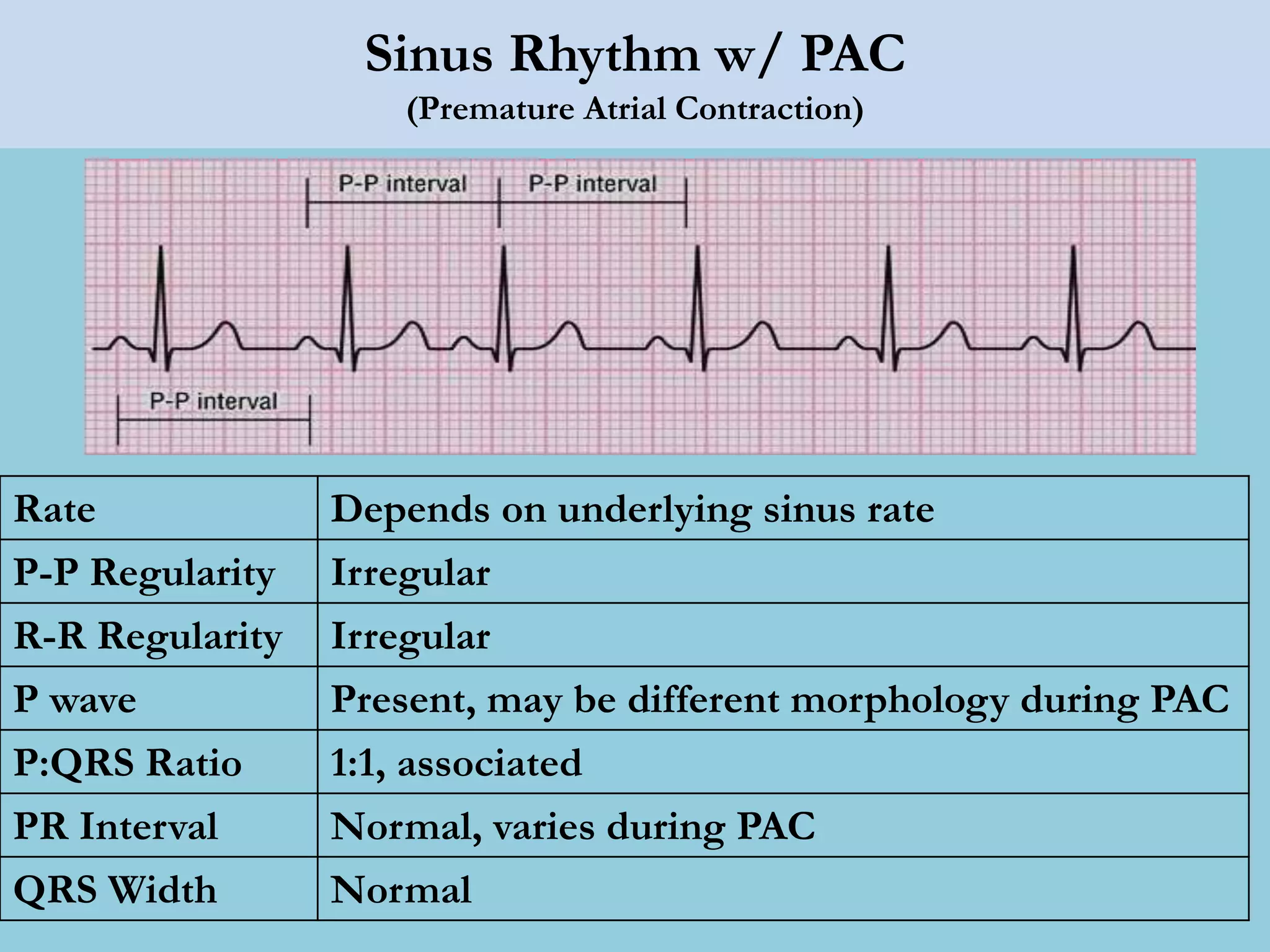 Lec 14 basic ecg interpretation for mohs | PPTX