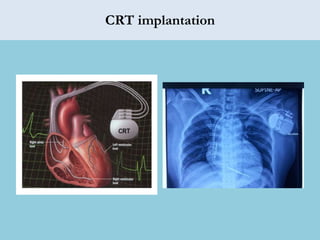 Lec 16 management of high risk patients for mohs | PPTX