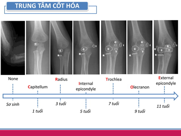 LEC 16 Y4_GaÌ y TLC xuÌ oÌ ng caÌ nh tay oÌ Ì treÌ em.pptx