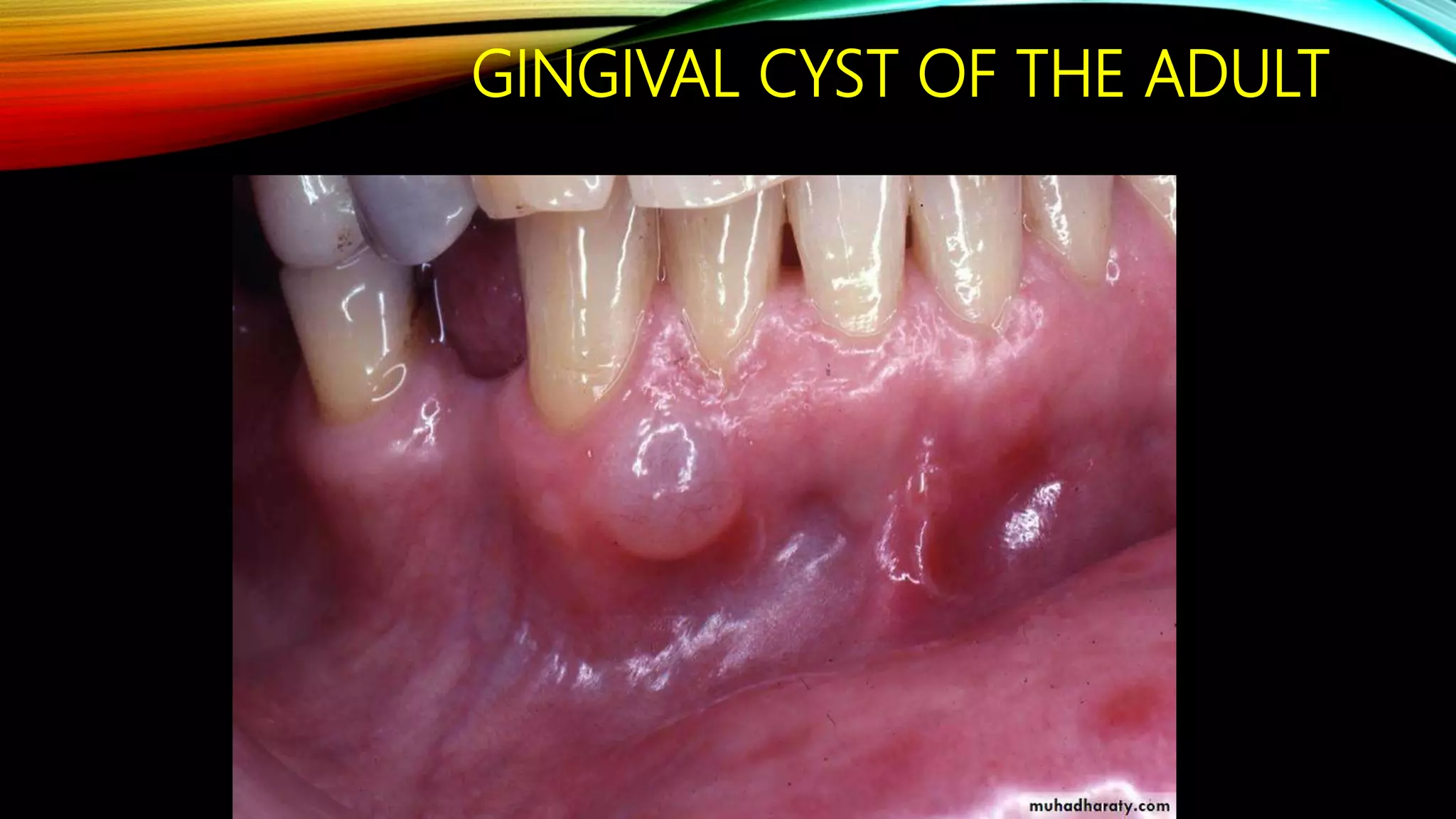 Lec 1 cysts of orofacial region | PPTX