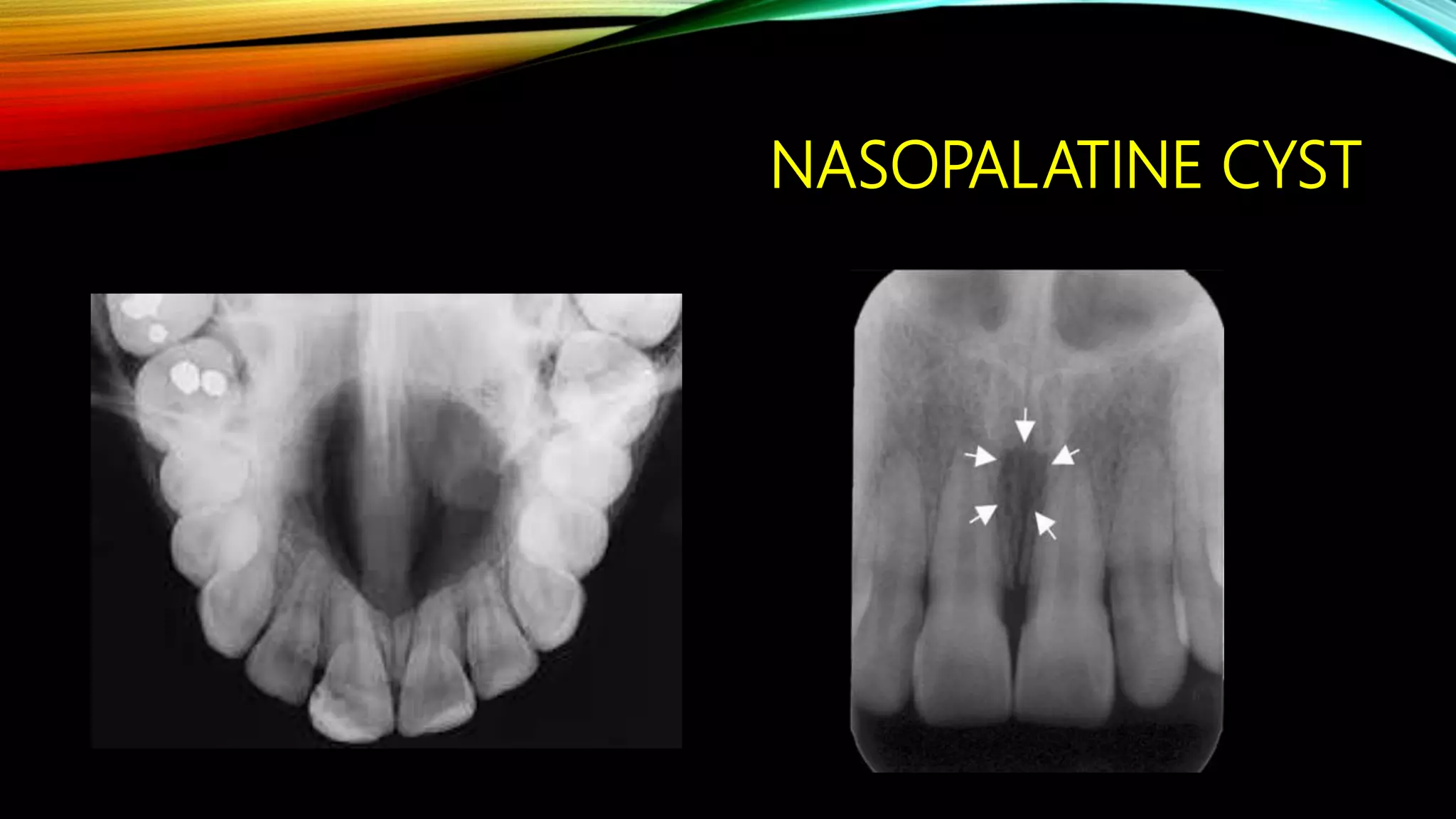 Lec 1 cysts of orofacial region | PPTX