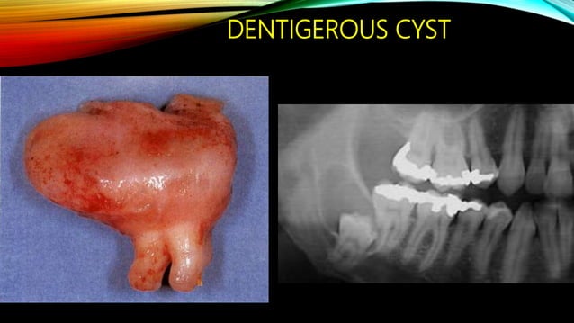Lec 1 cysts of orofacial region | PPTX | Dental Health | Diseases and ...