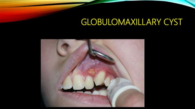 Lec 1 cysts of orofacial region | PPTX | Dental Health | Diseases and ...