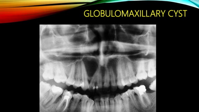 Lec 1 cysts of orofacial region | PPTX | Dental Health | Diseases and ...