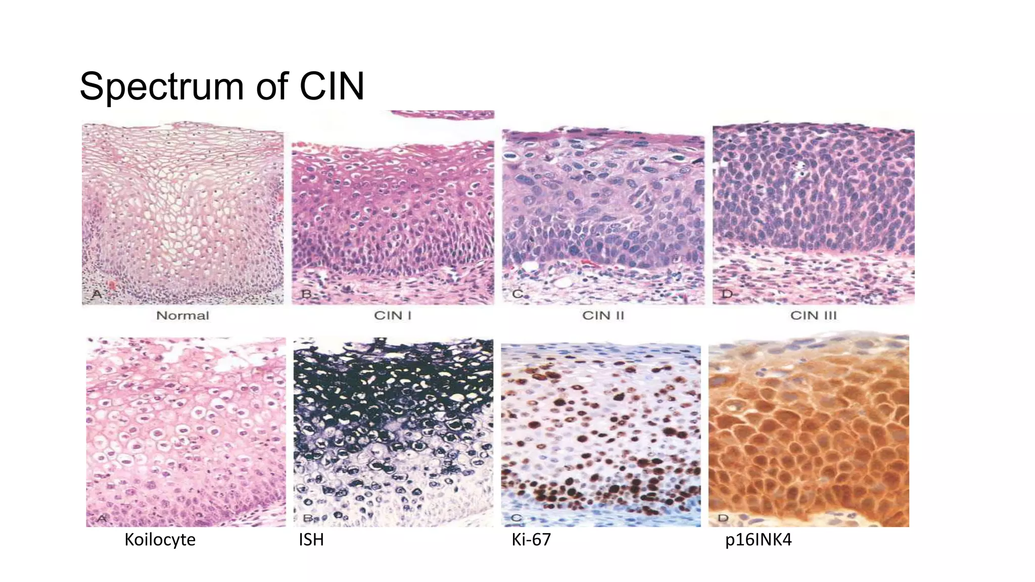 Lec 24 24 female reproductive system pathology | PPTX