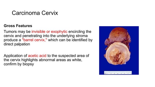 Lec 24 24 female reproductive system pathology | PPTX