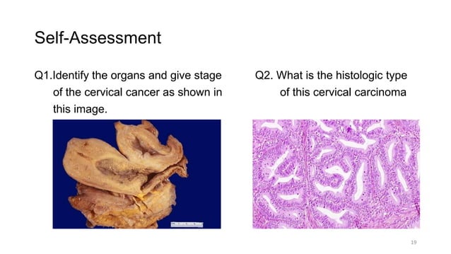 Lec 24 24 female reproductive system pathology | PPTX