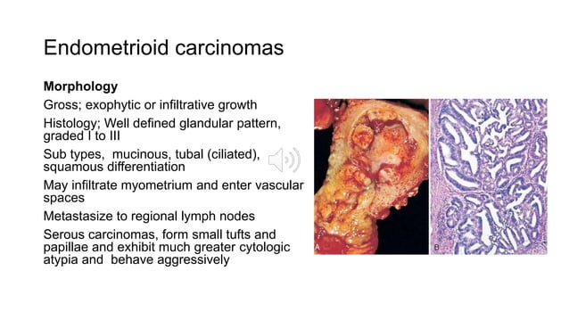 Lec 24 24 female reproductive system pathology | PPTX