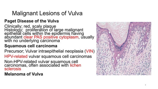 Lec 24 24 female reproductive system pathology | PPTX