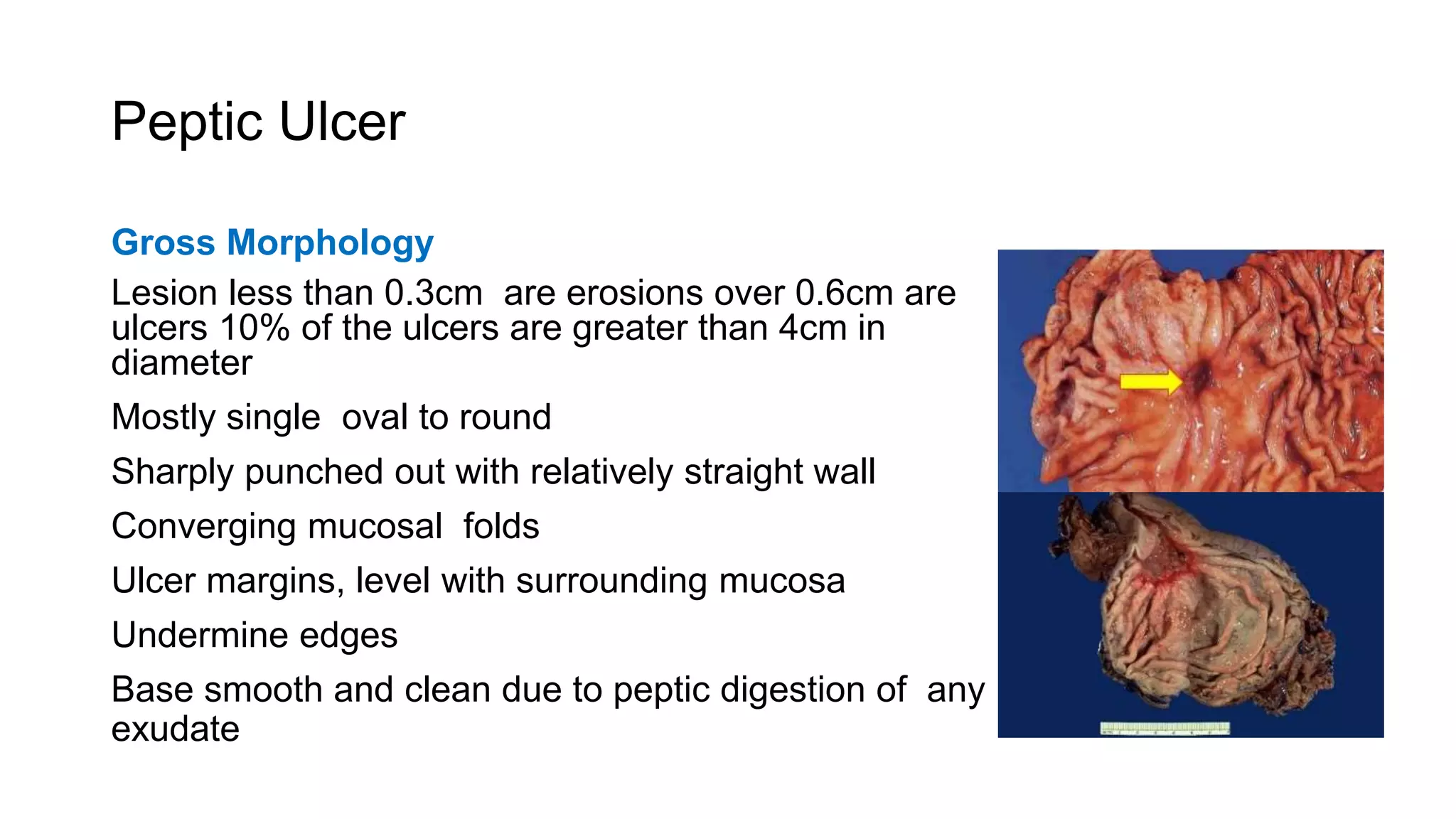 Lec 2 gastritis, gastric neoplasm | PPTX
