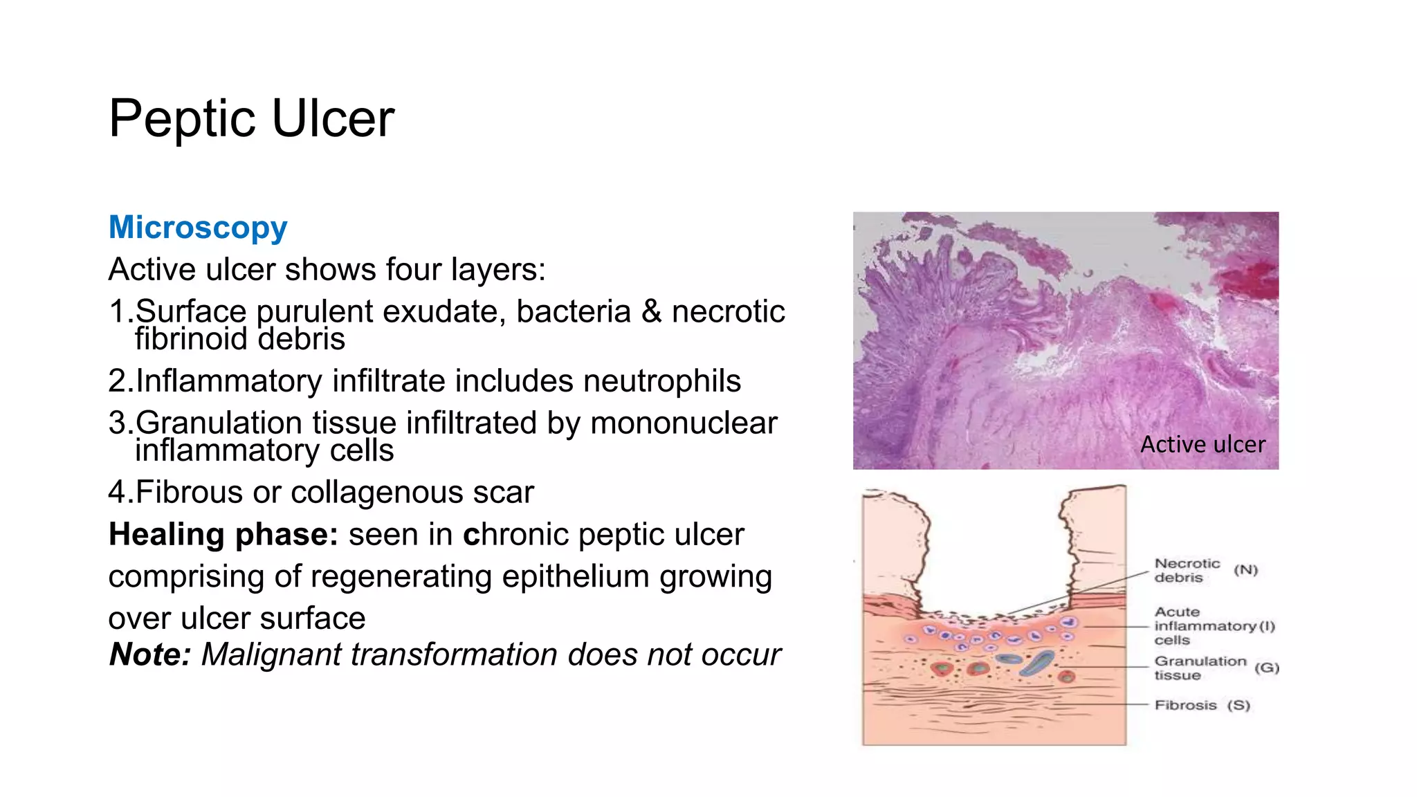 Lec 2 gastritis, gastric neoplasm | PPTX