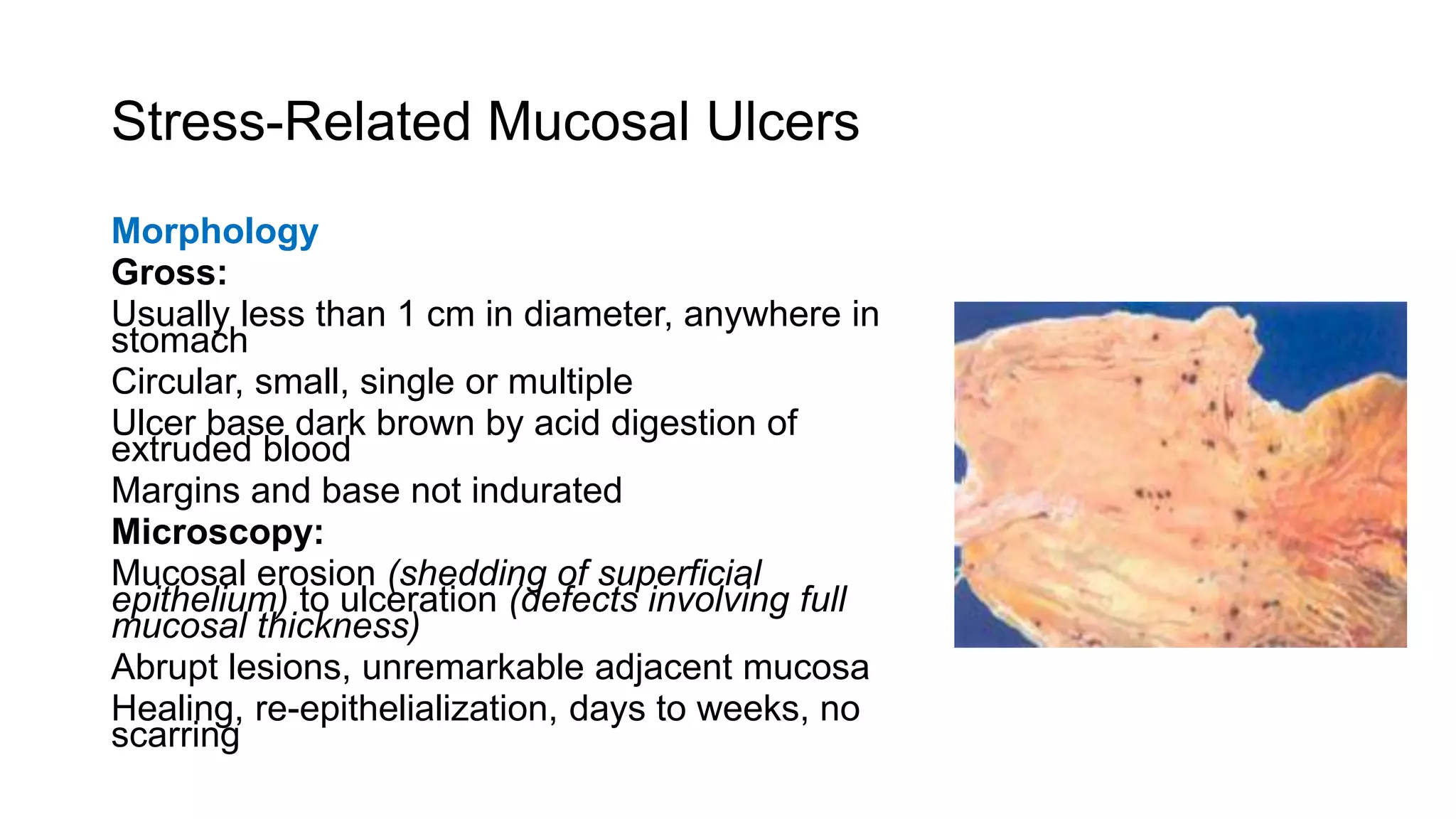 Lec 2 gastritis, gastric neoplasm | PPTX