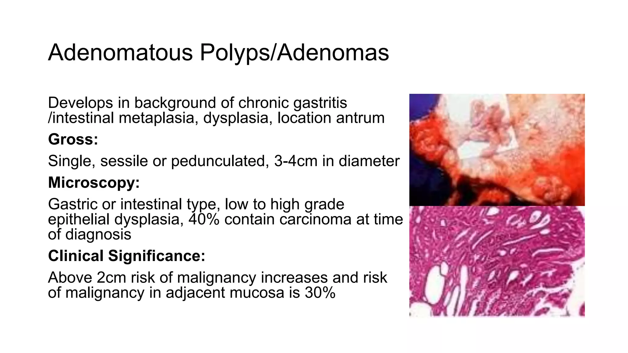 Lec 2 gastritis, gastric neoplasm | PPTX