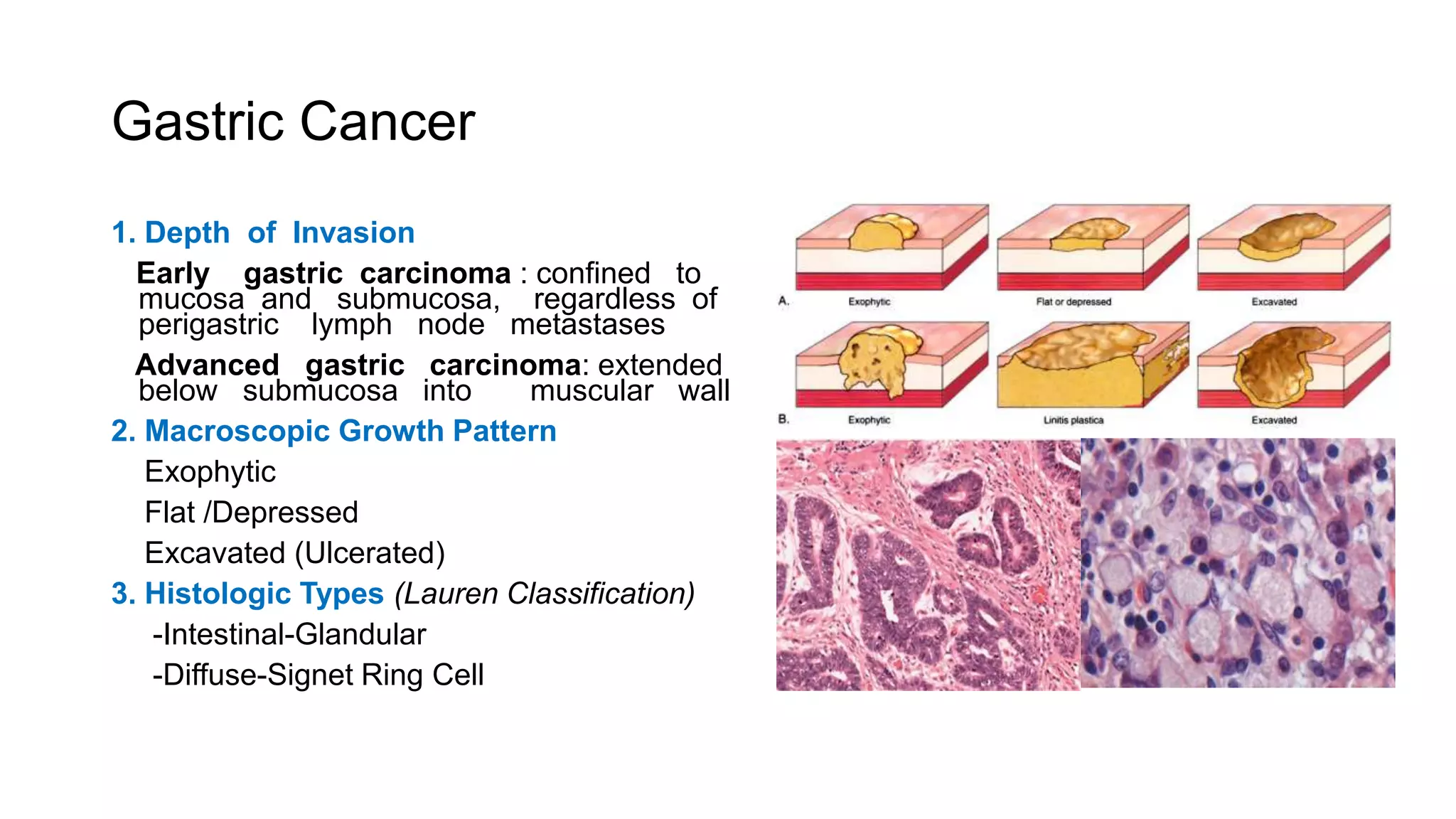 Lec 2 gastritis, gastric neoplasm | PPTX