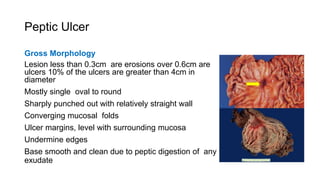 Lec 2 gastritis, gastric neoplasm | PPTX | Digestive Disorders ...