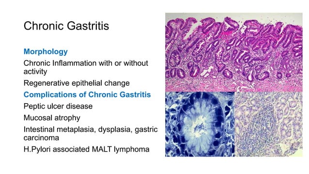 Lec 2 gastritis, gastric neoplasm | PPT