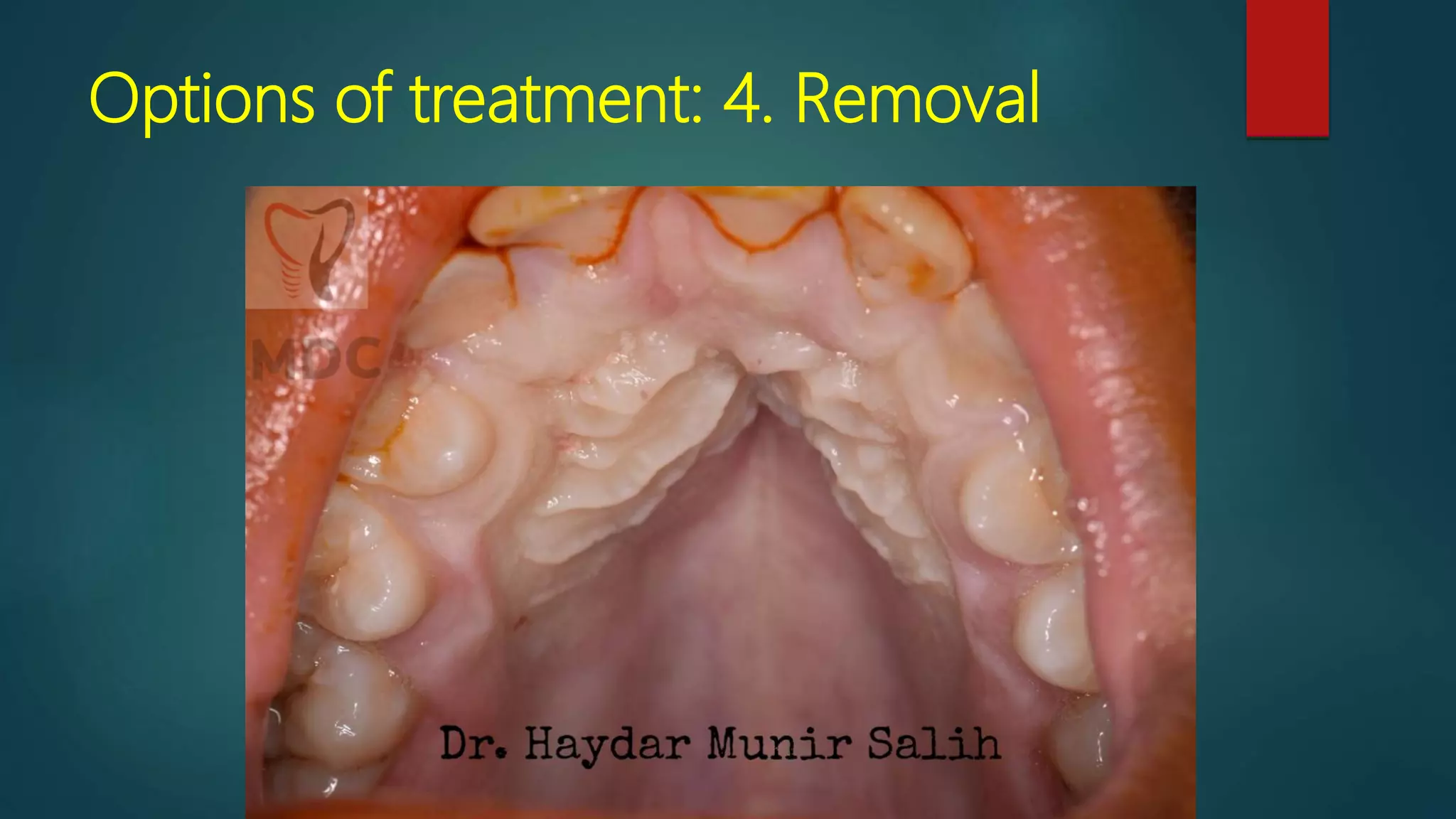 Lec 2 principles of management of impacted teeth | PPTX