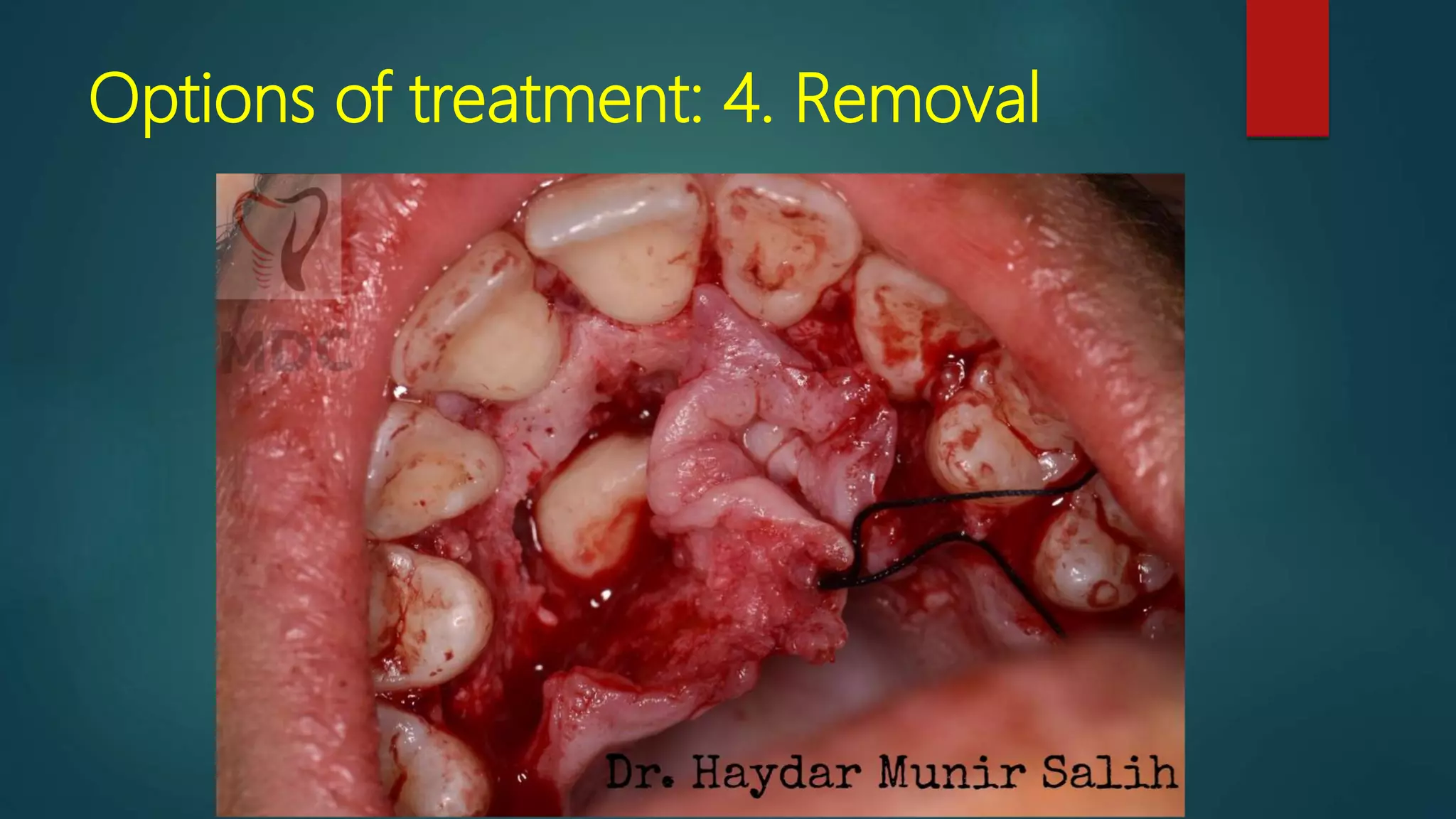 Lec 2 principles of management of impacted teeth | PPTX