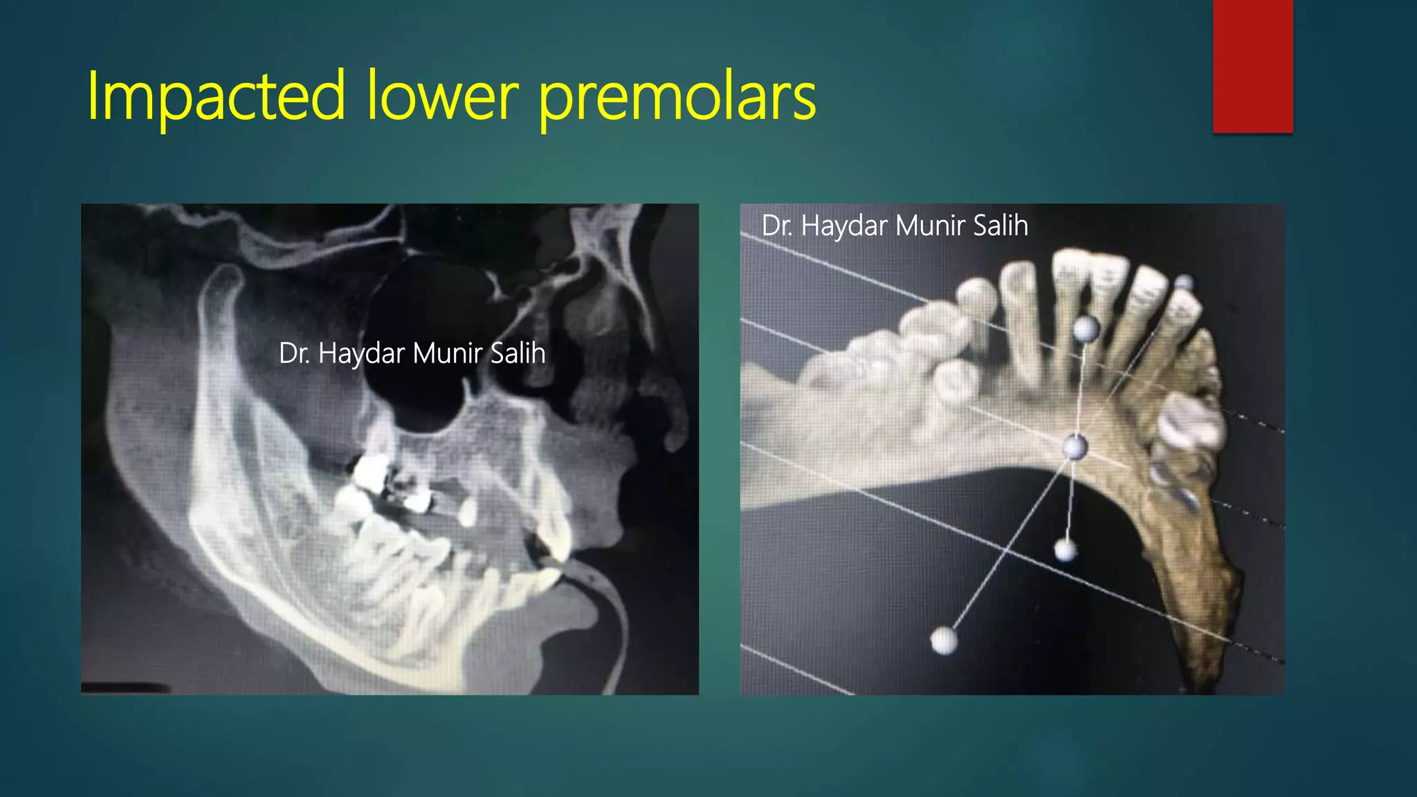 Lec 2 principles of management of impacted teeth | PPTX