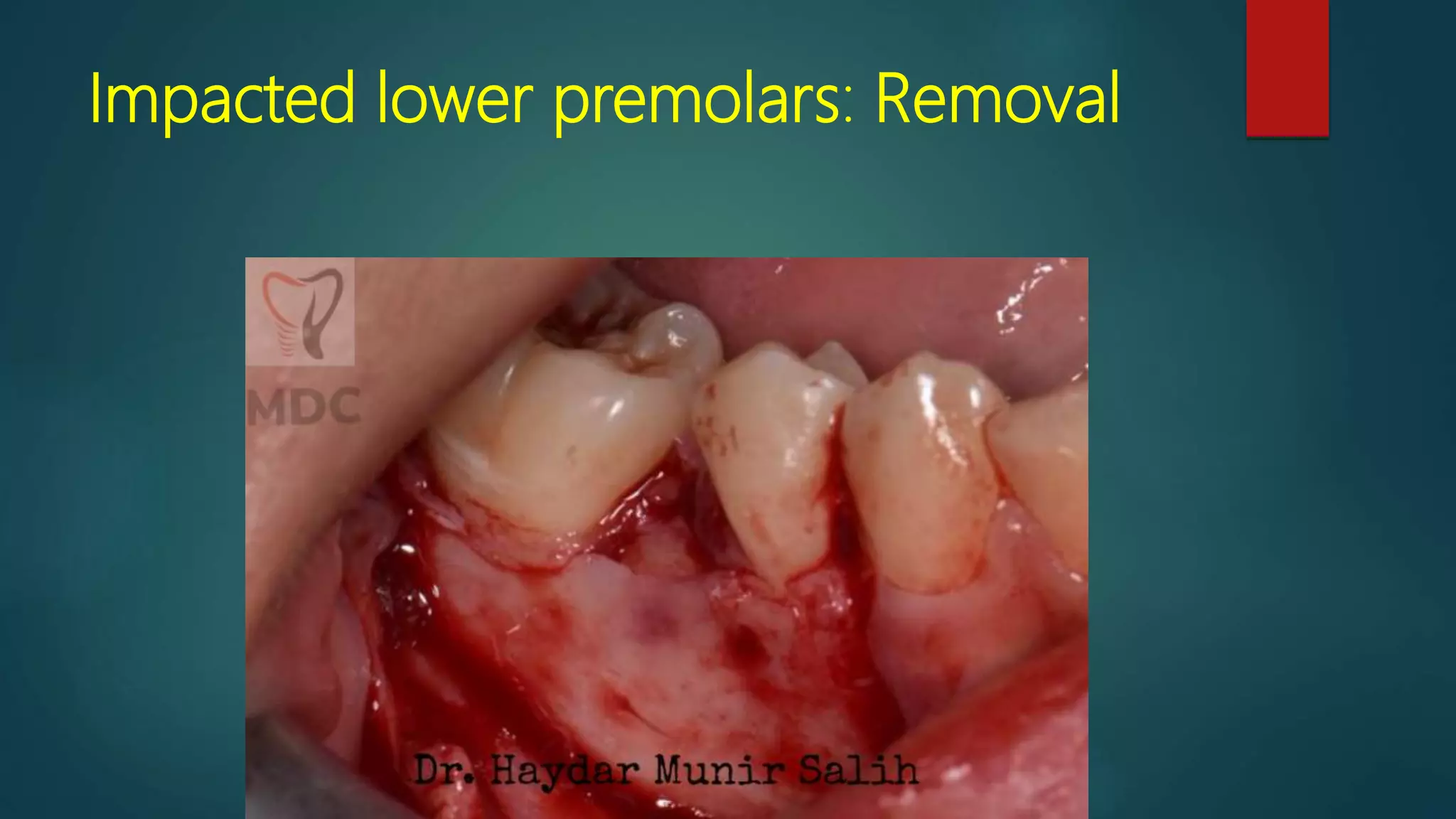 Lec 2 principles of management of impacted teeth | PPTX
