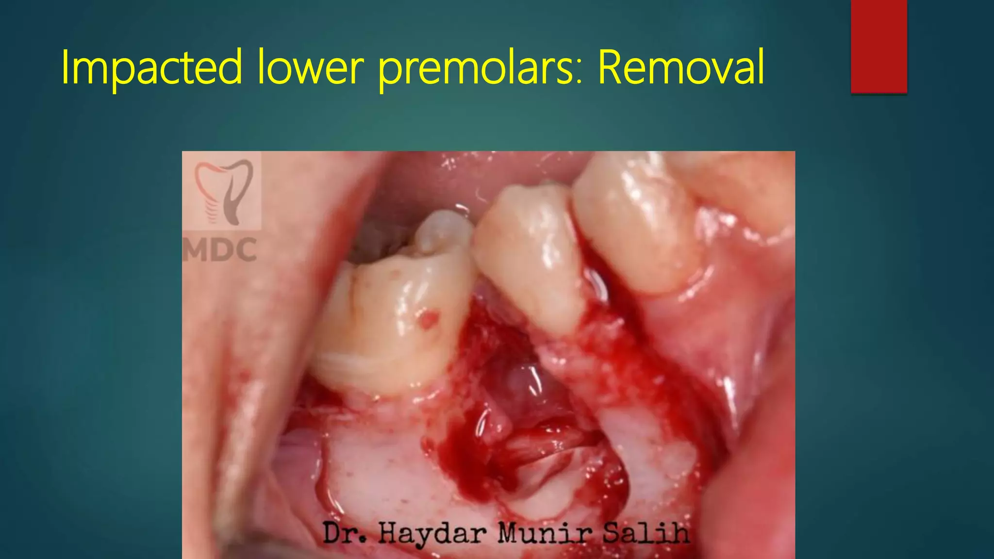 Lec 2 principles of management of impacted teeth | PPTX