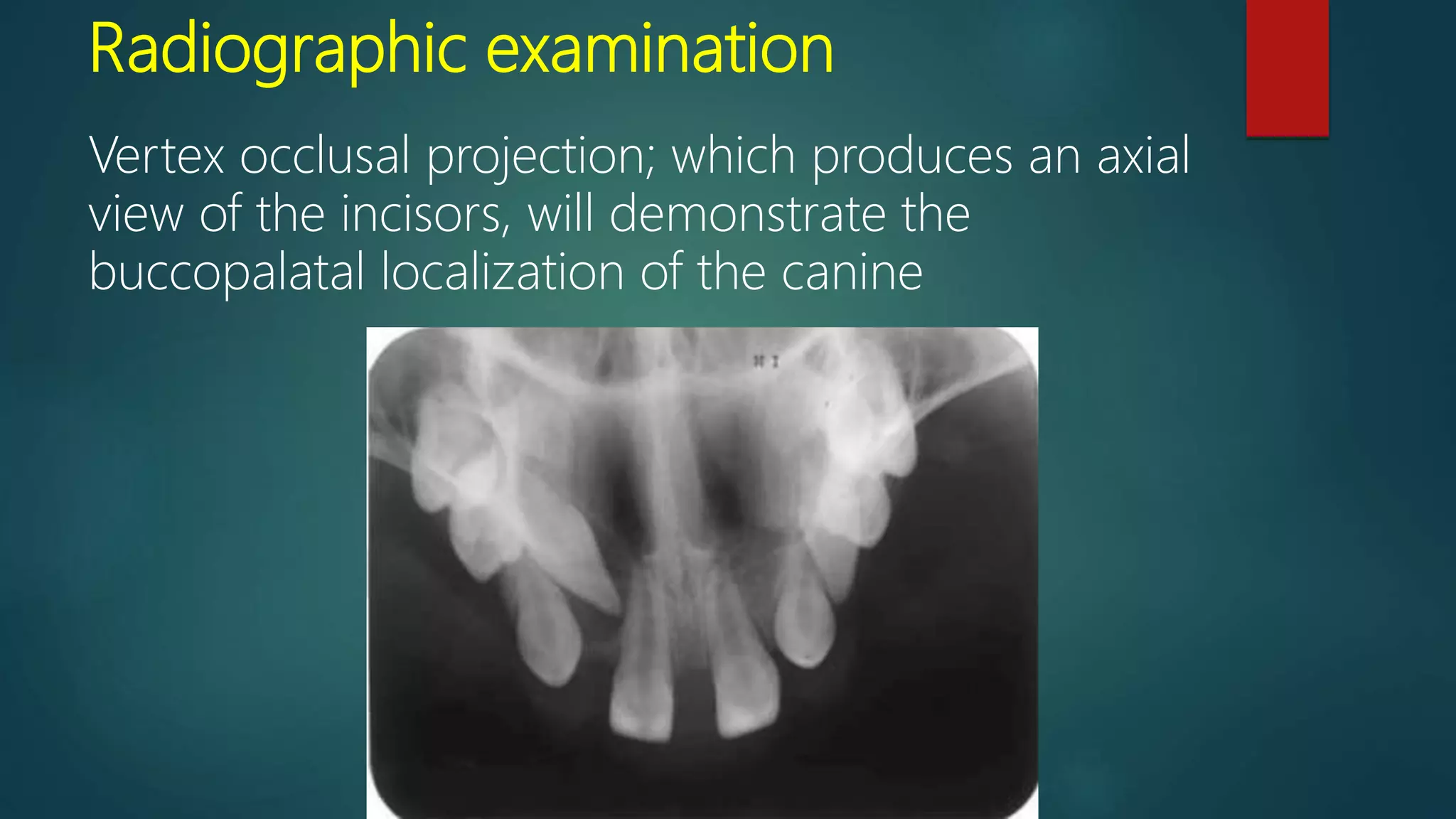 Lec 2 principles of management of impacted teeth | PPTX