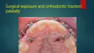 Lec 2 principles of management of impacted teeth | PPTX