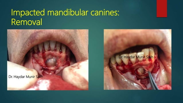 Lec 2 principles of management of impacted teeth | PPT