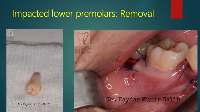Lec 2 principles of management of impacted teeth | PPT
