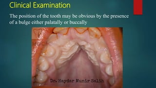 Lec 2 principles of management of impacted teeth | PPTX