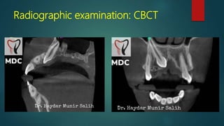 Lec 2 principles of management of impacted teeth | PPT