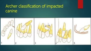 Lec 2 principles of management of impacted teeth | PPT