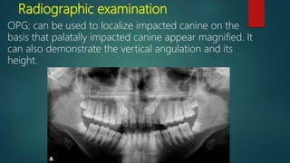 Lec 2 principles of management of impacted teeth | PPT