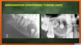 LEC 2: ODONTOGENIC TUMORS AND TUMOR LIKE LESIONS OF THE JAW | PPTX