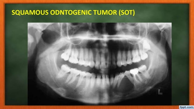 LEC 2: ODONTOGENIC TUMORS AND TUMOR LIKE LESIONS OF THE JAW | PPTX