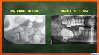 LEC 2: ODONTOGENIC TUMORS AND TUMOR LIKE LESIONS OF THE JAW | PPTX