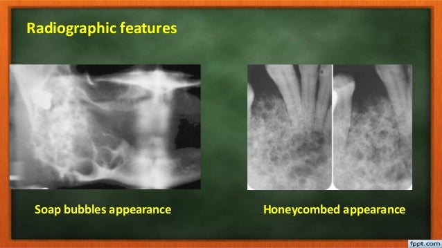LEC 2: ODONTOGENIC TUMORS AND TUMOR LIKE LESIONS OF THE JAW