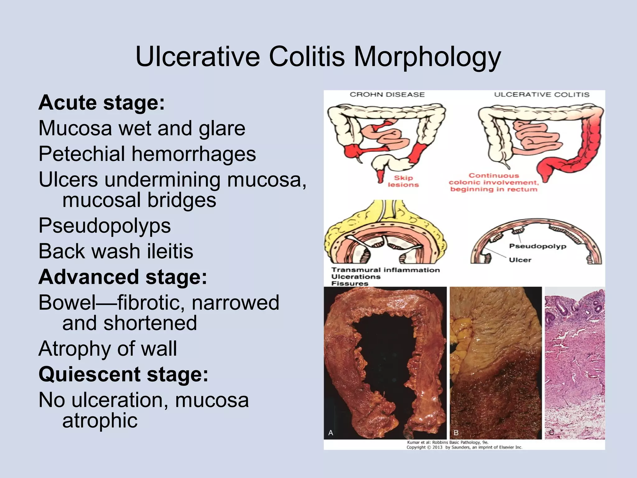 IBD and appendicitis | PPT