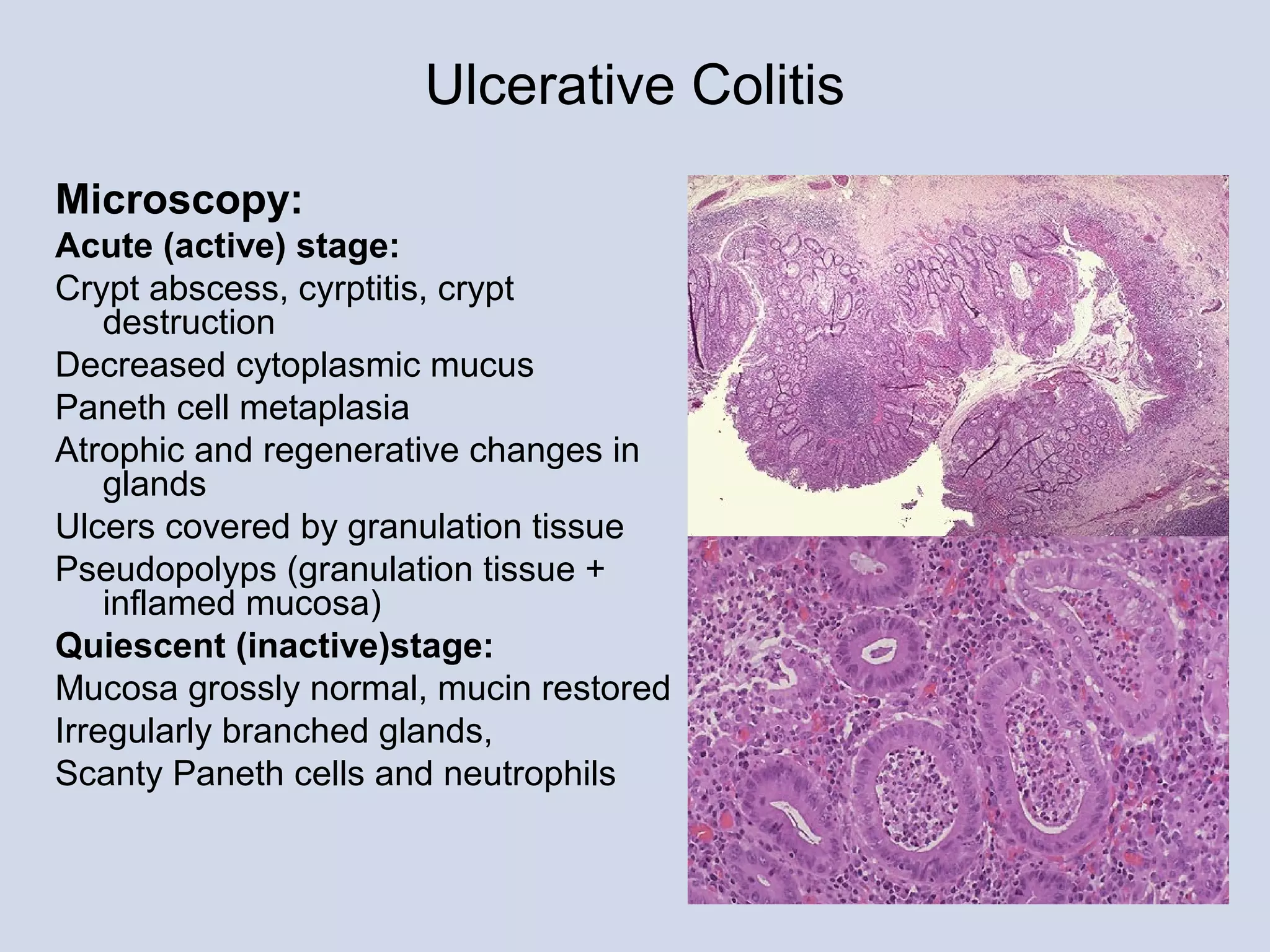 IBD and appendicitis | PPT