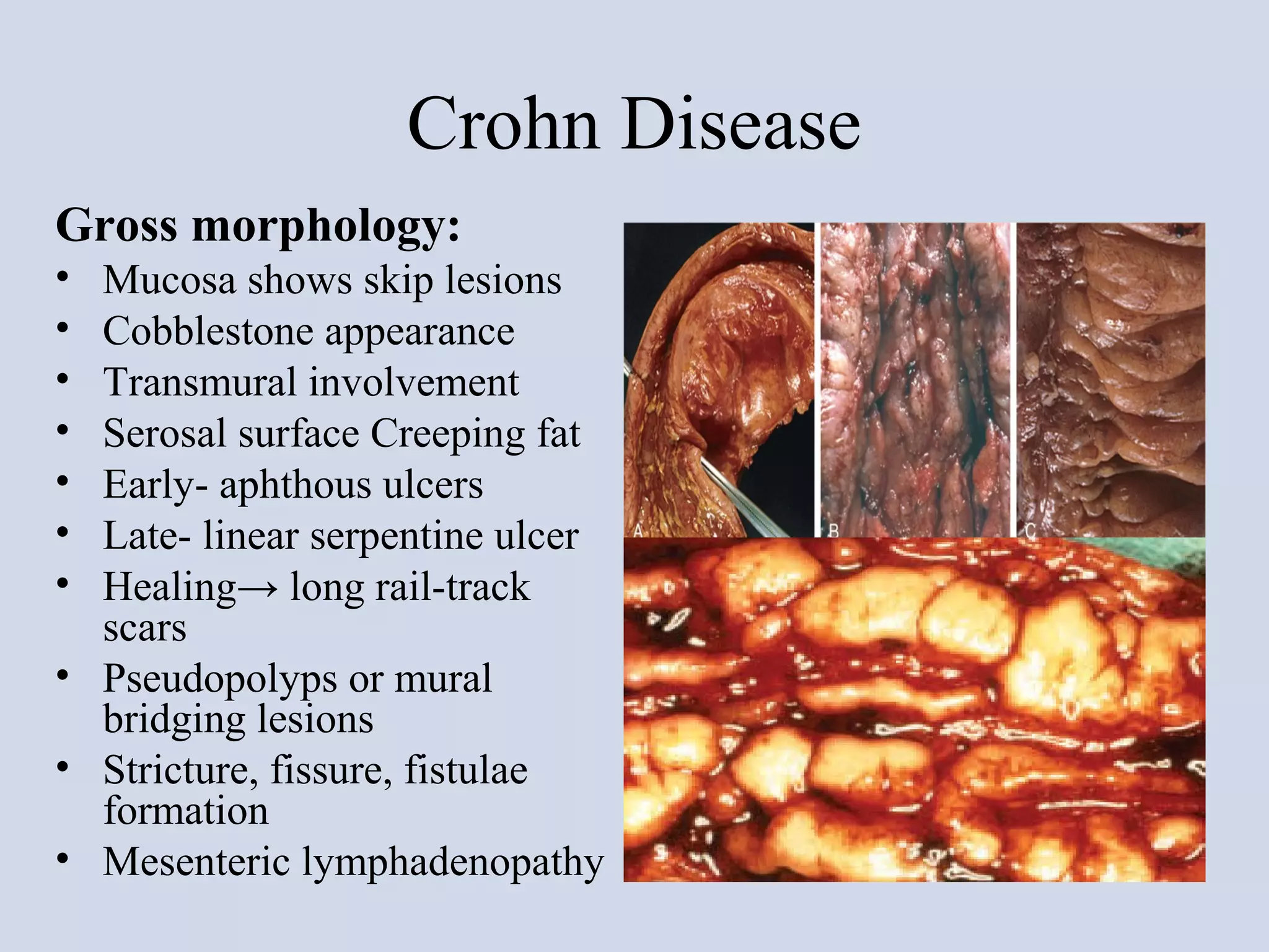 IBD and appendicitis | PPT