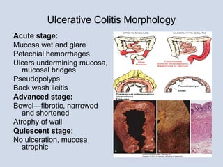 IBD and appendicitis | PPT