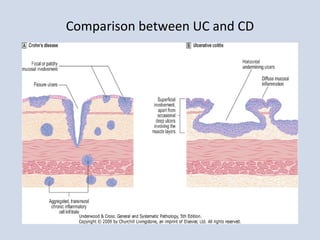 IBD and appendicitis | PPT | Digestive Disorders | Diseases and Conditions